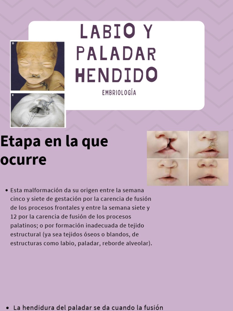 Labio y Paladar Hendido | PDF | Medicina CLINICA | Especialidades Medicas