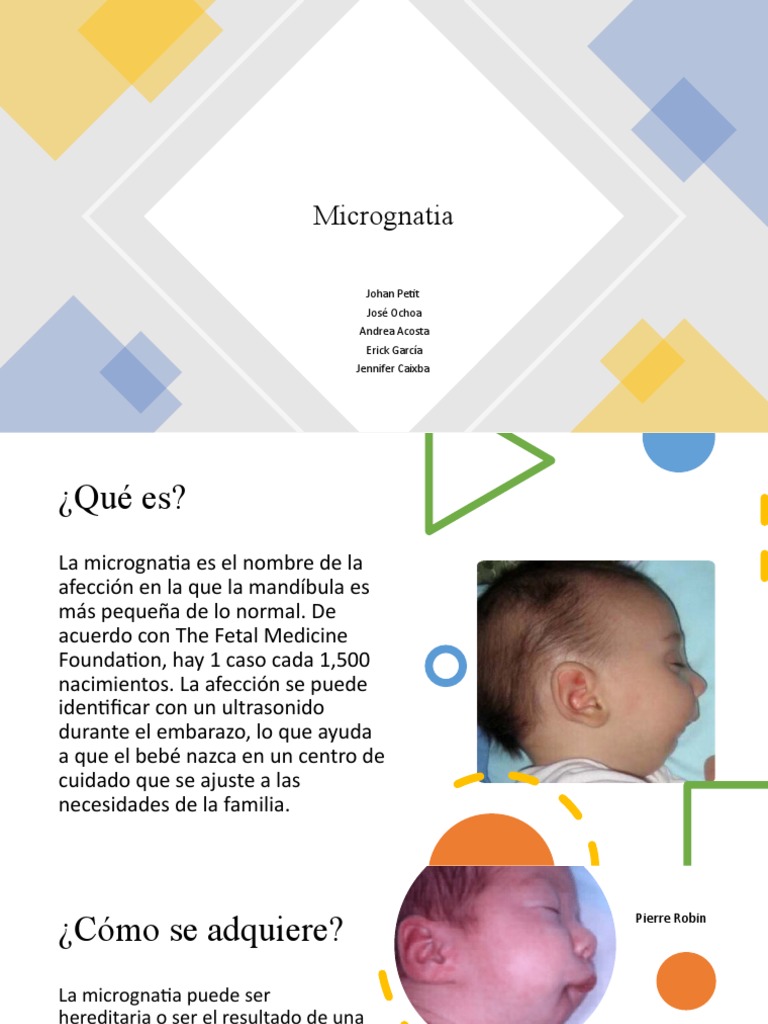 Micrognatia | PDF | Ciencias de la Salud | Epidemiología
