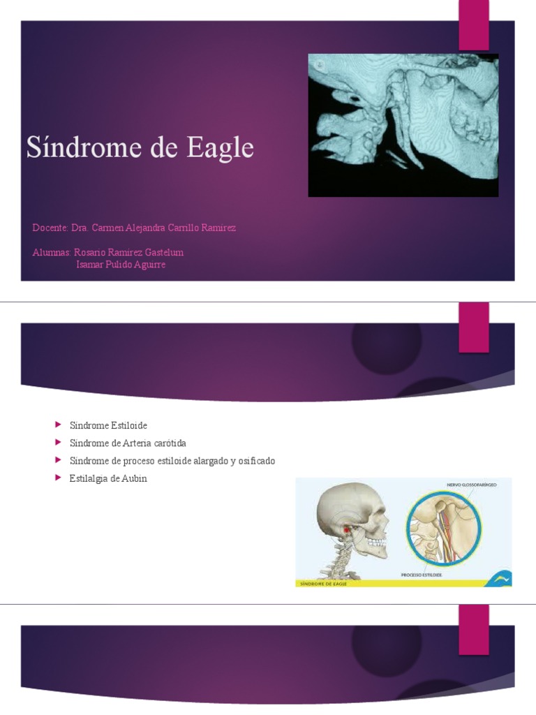 Sindrome de Eagle | PDF | Medicina | Cabeza y cuello humanos