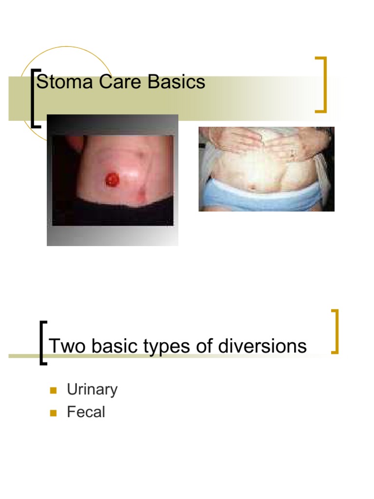 Double Barrel Ureterostomy Insights | PDF | Digestive System ...