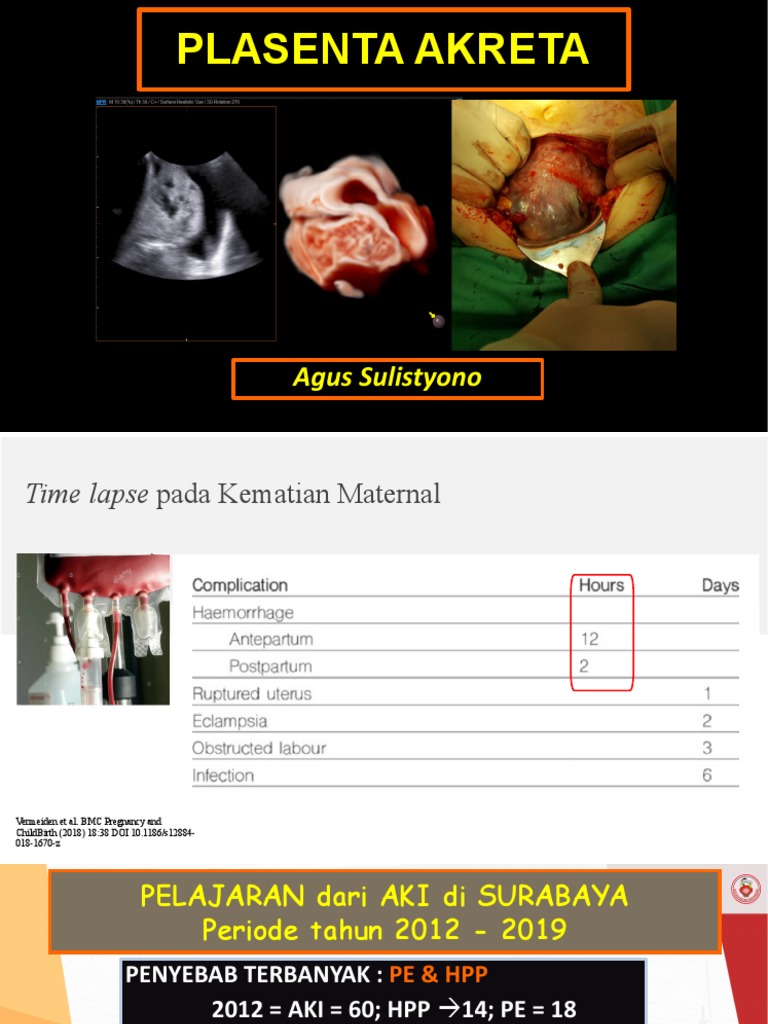 Plasenta Akreta PONEK PDF | PDF | Placenta | Caesarean Section