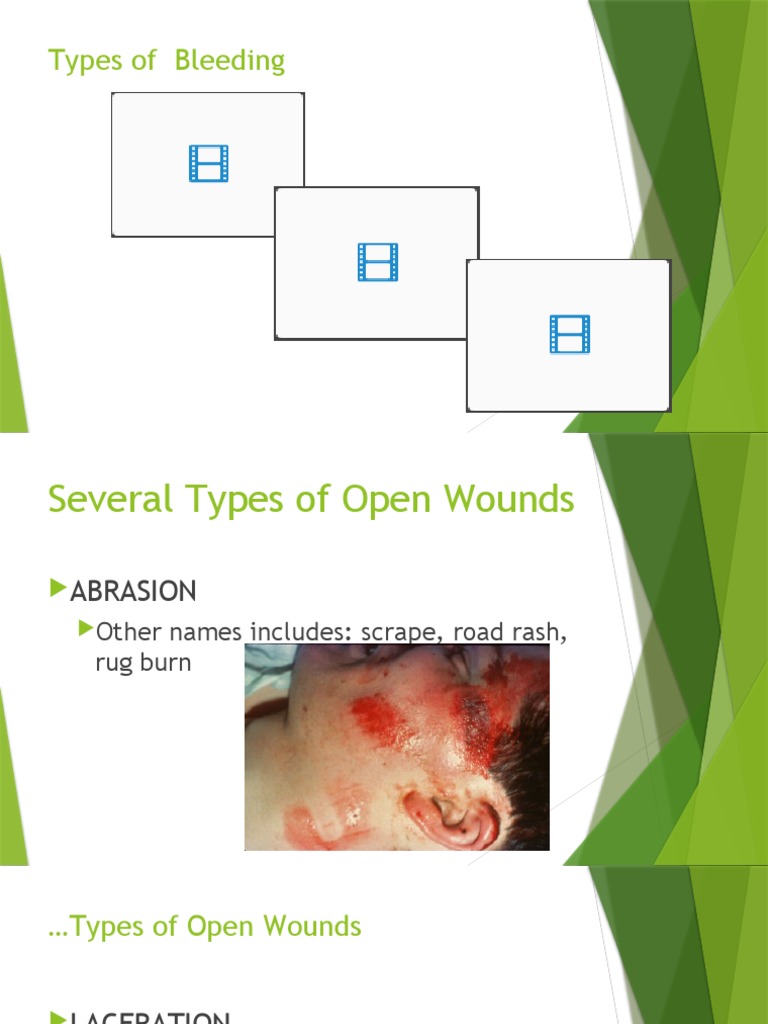 Types of Bleeding | Download Free PDF | Wound | Bleeding