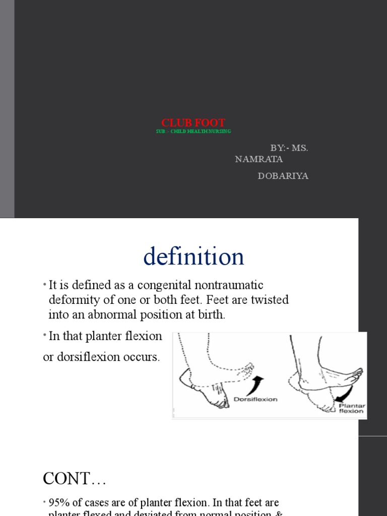 Understanding Club Foot in Children | PDF