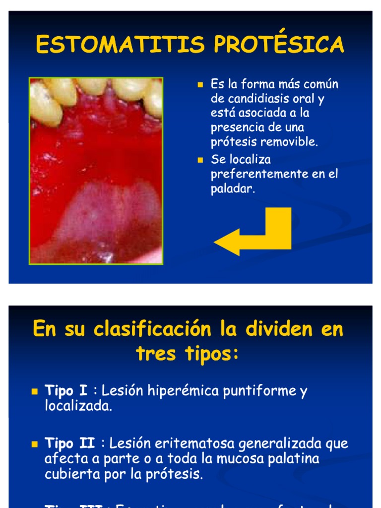 ESTOMATITIS PROTESICA