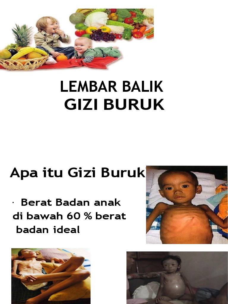 Lembar Balik Gizi Buruk 2 | PDF | Gaya Hidup
