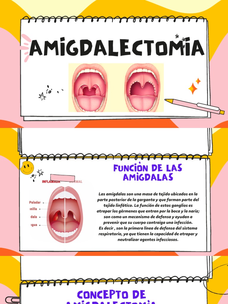 Amigdalectomia | PDF