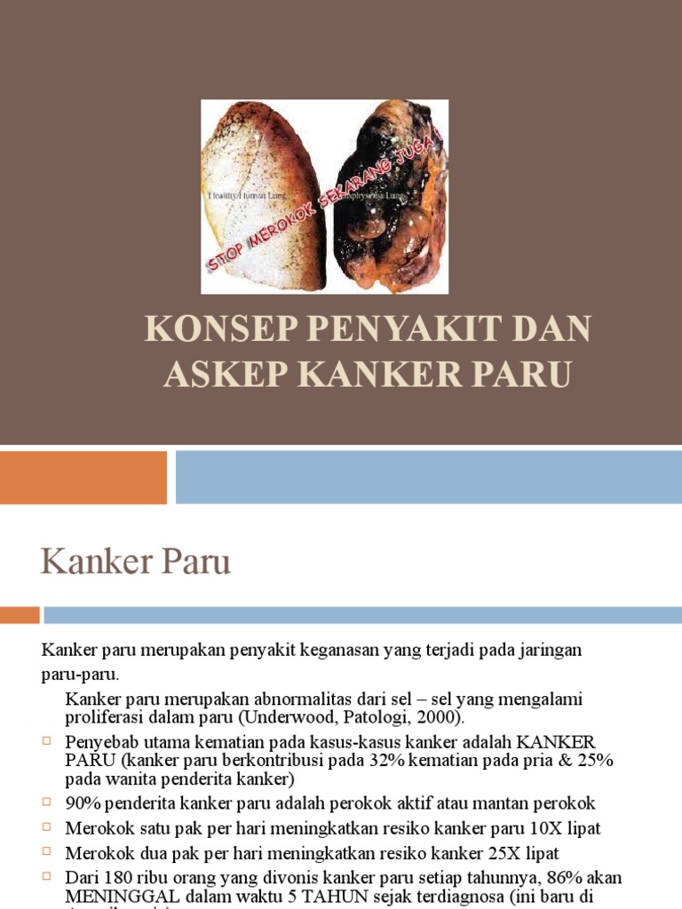 Kanker Paru | PDF