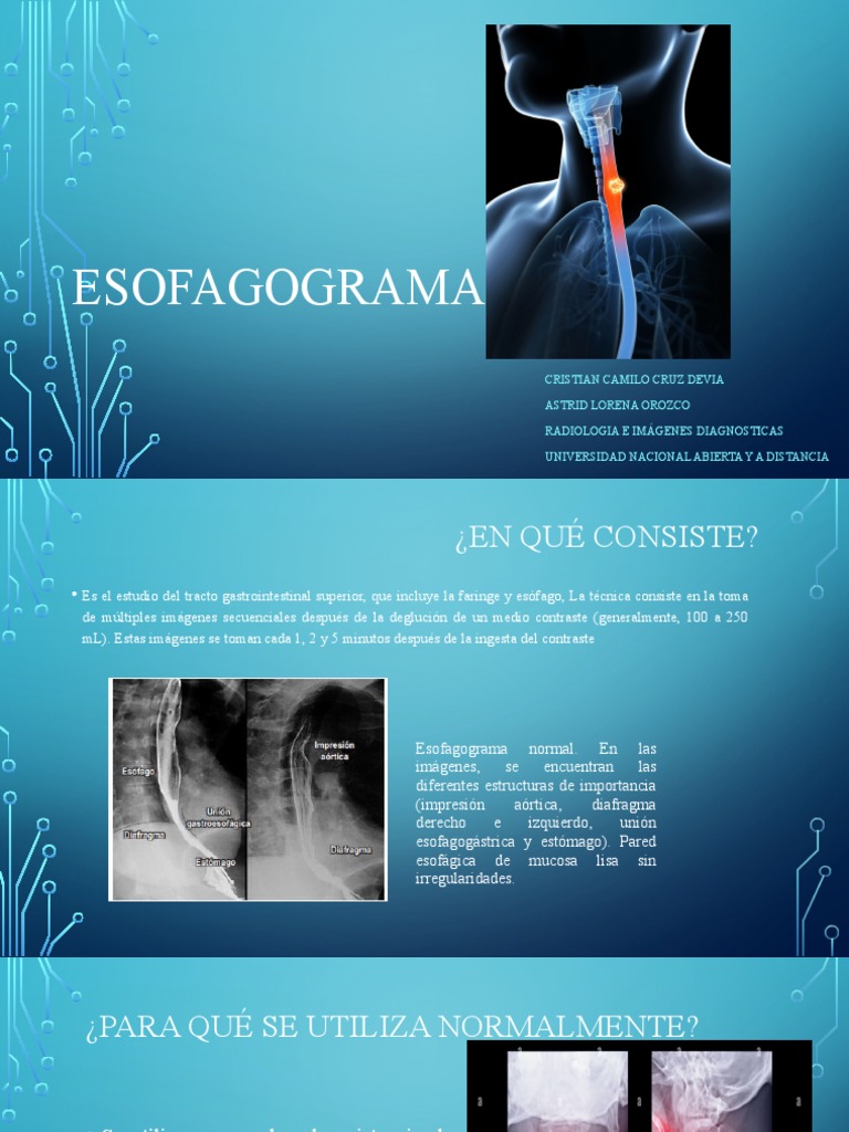ESOFAGOGRAMA | Descargar gratis PDF | Acidez | Estómago