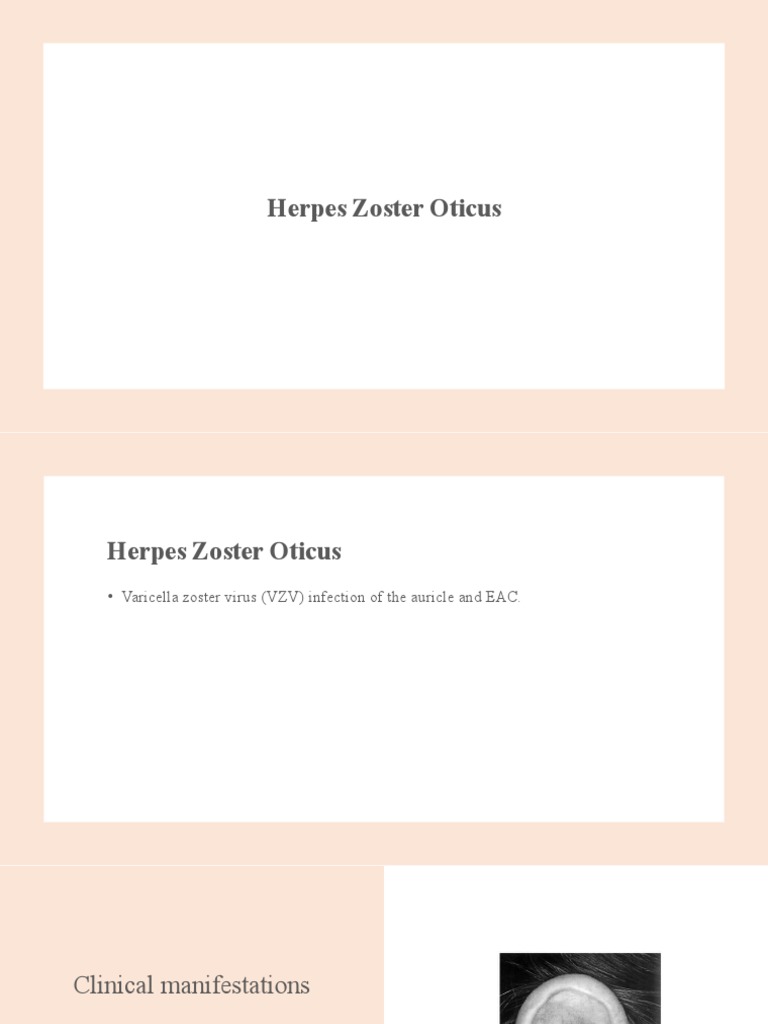 Herpes Zoster Oticus | PDF | Diseases And Disorders | Viral Diseases