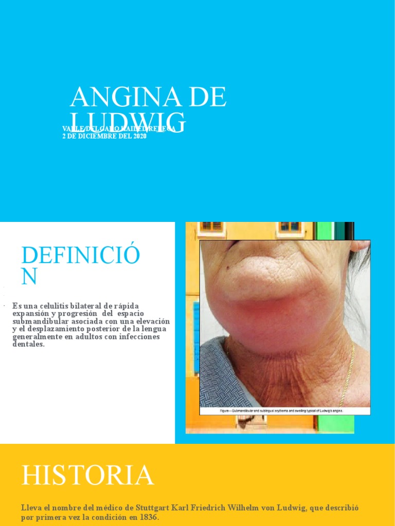 Angina de Ludwig: Definición y Tratamiento | PDF