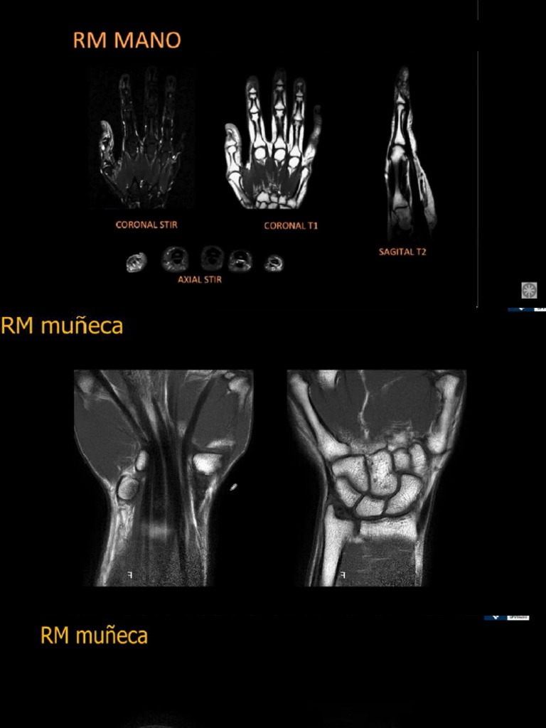RESONANCIA MAGNETICA MANO Y MUÑECA - G | PDF