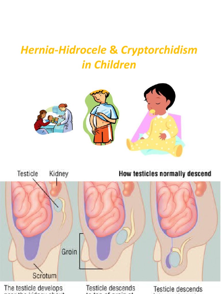 Hernia, Hidrocele & Cryptorchidism in Children | PDF