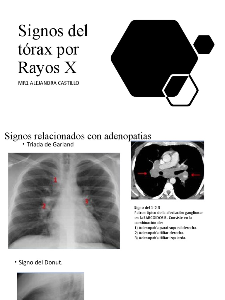Signos Del Torax Por Rayos X | PDF | Pulmón | Corazón