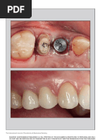 Catalog Frialit Xive | PDF | Dental Implant | Prosthesis