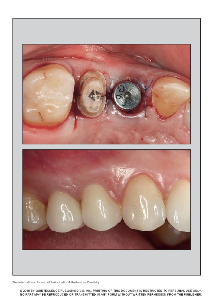 The International Journal of Periodontics & Restorative Dentistry | PDF ...