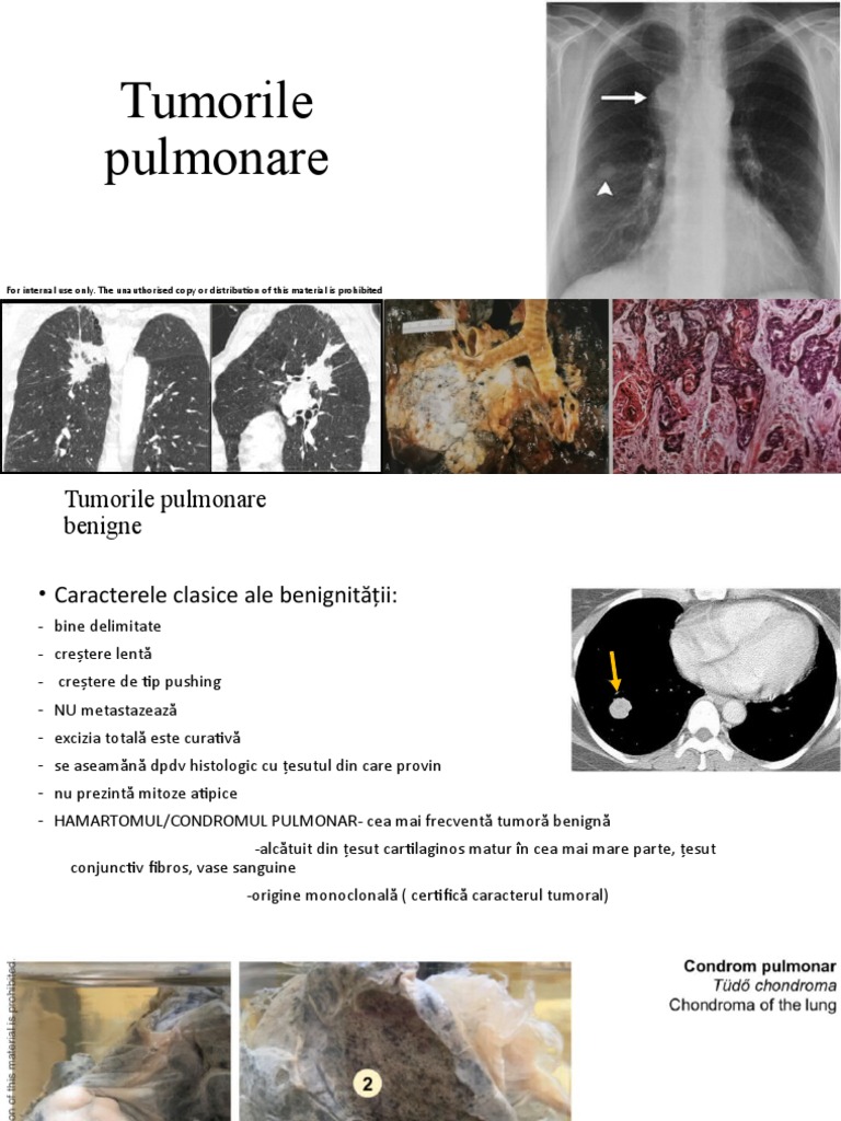 Lp4 Pulmonar Tumoral | PDF