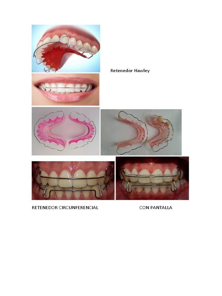 Retenedor Hawley IMAGENES | PDF