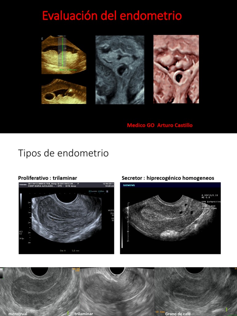 Ieta Ovario Castillo | PDF | Neoplasias | Ginecología