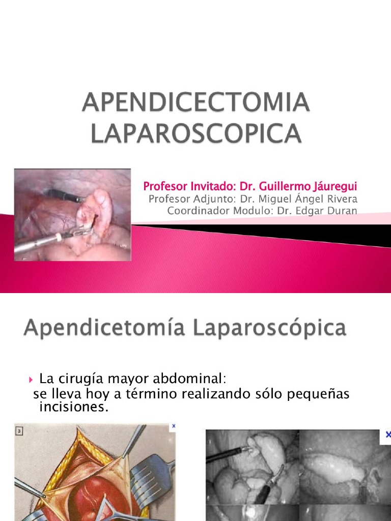 Apendicectomia Laparoscopica | PDF