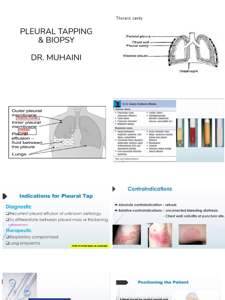 (CSL8) Pleural Tap & Biopsy | PDF