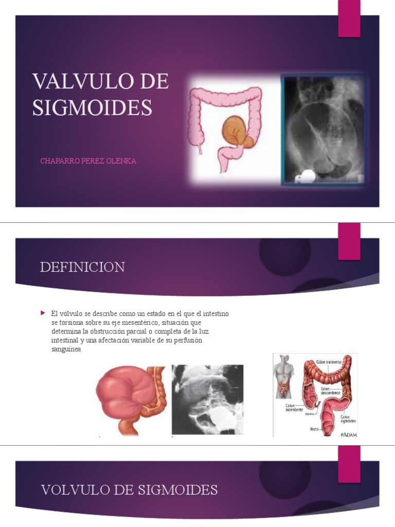Valvulo de Sigmoides | PDF | Intestino grueso | Abdomen