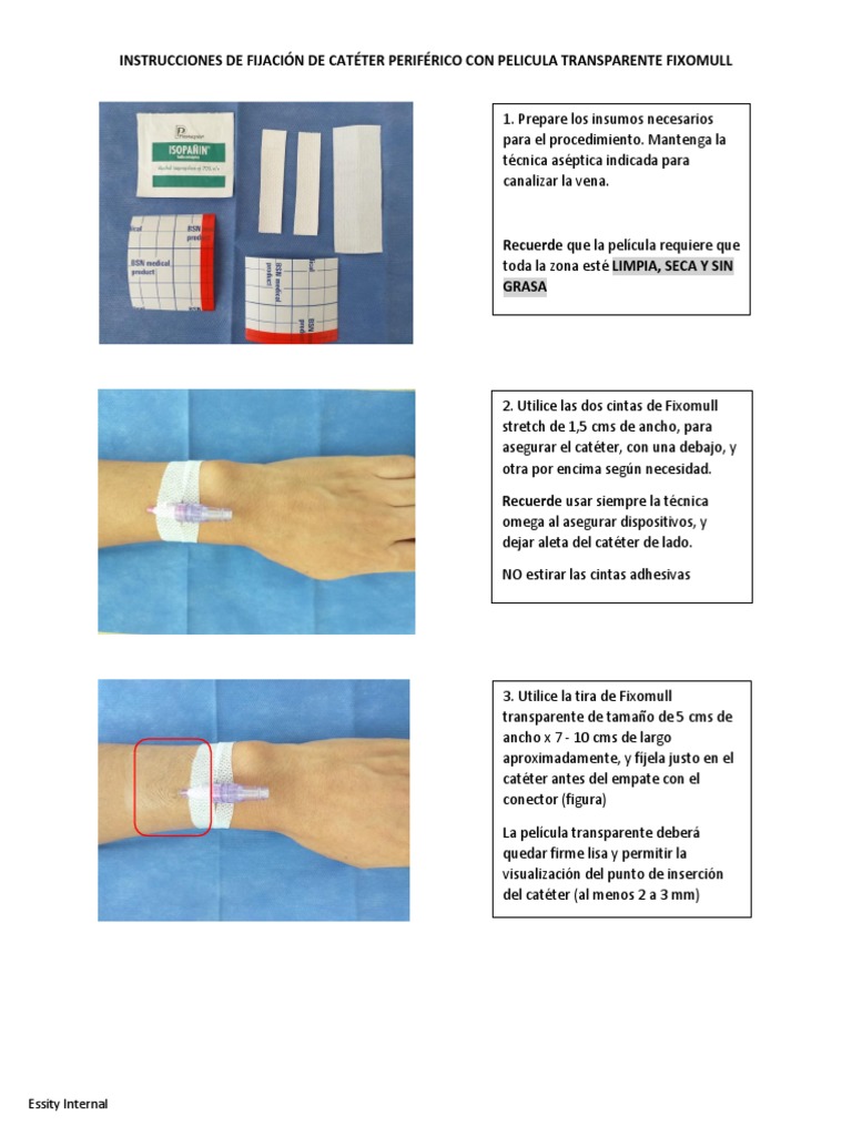 Instrucciones Fijacion Cateter Con Fixomull Transparente | PDF
