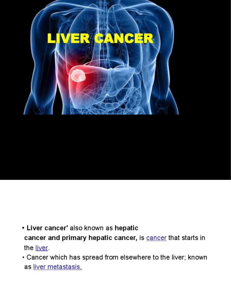Liver Cancer | Download Free PDF | Cancer | Hepatitis