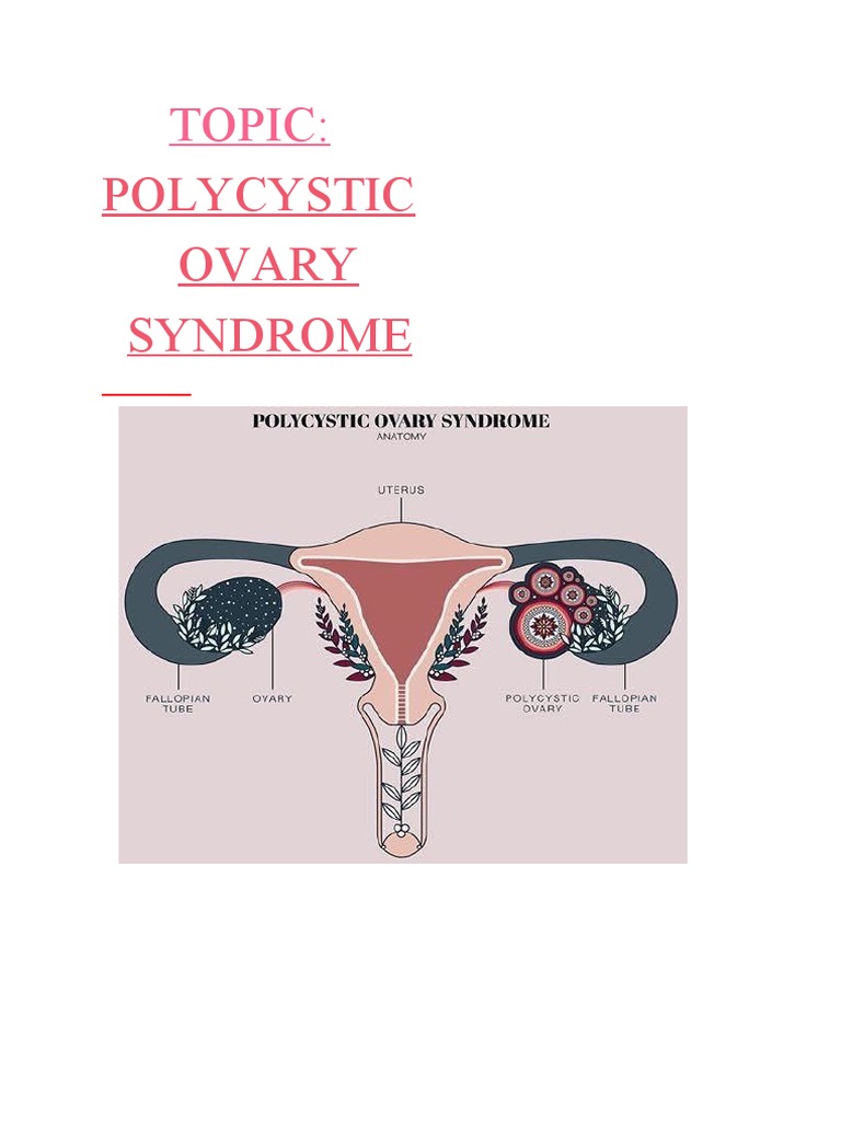 Pcos Investigatory Project | PDF
