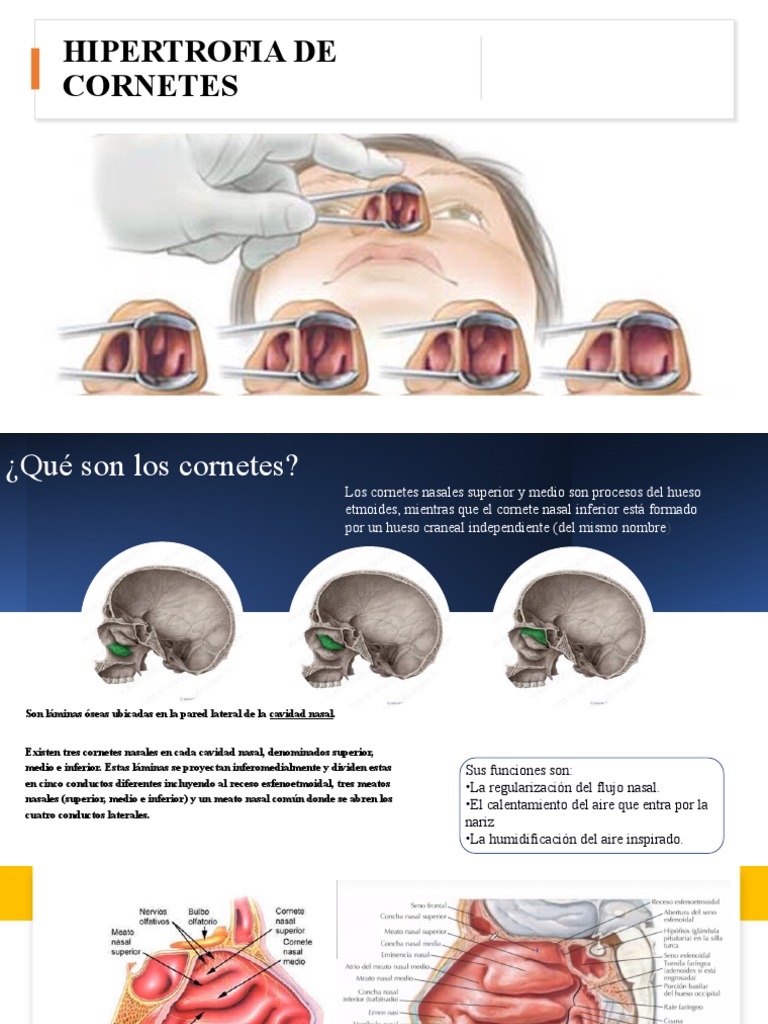 Hipertrofia de Cornetes | PDF