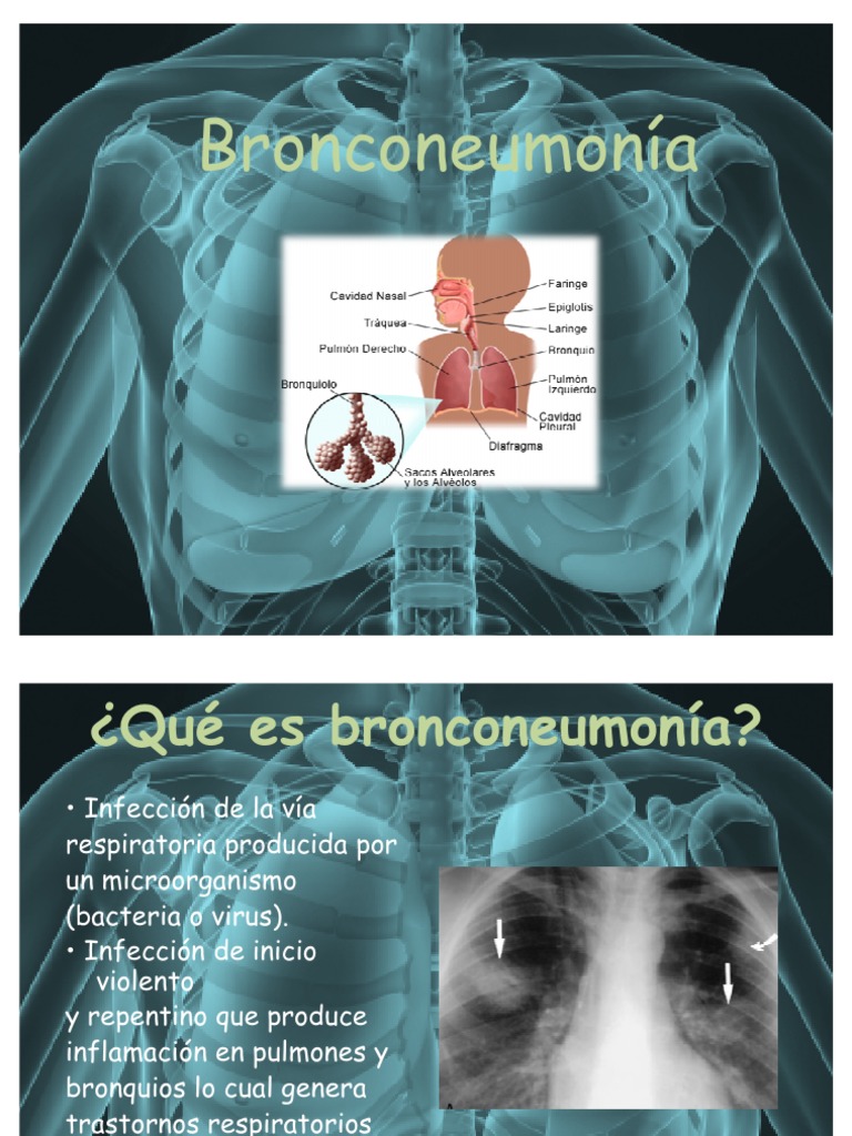 Bronconeumonía - PPTX | PDF