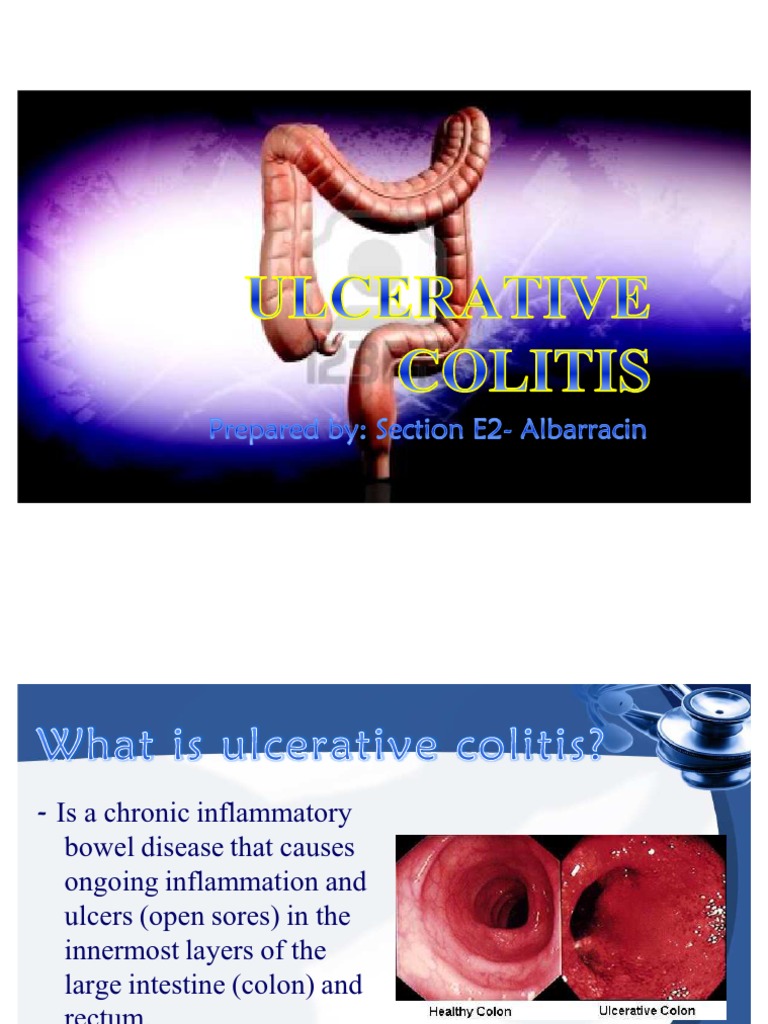 Ulcerative Colitis: Stool Analysis | PDF