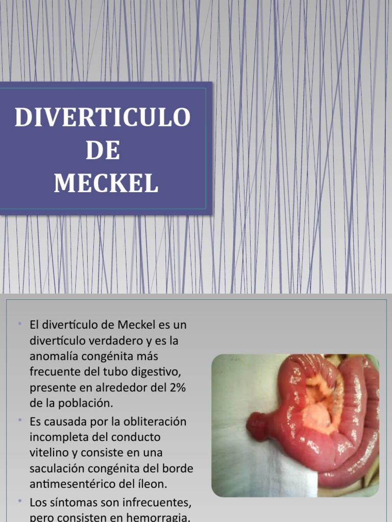 Diverticulo de Meckel | PDF | Epidemiología | Enfermedades y trastornos ...