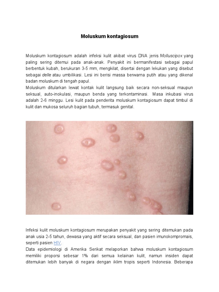 Moluskum Kontagiosum: Panduan Lengkap | PDF