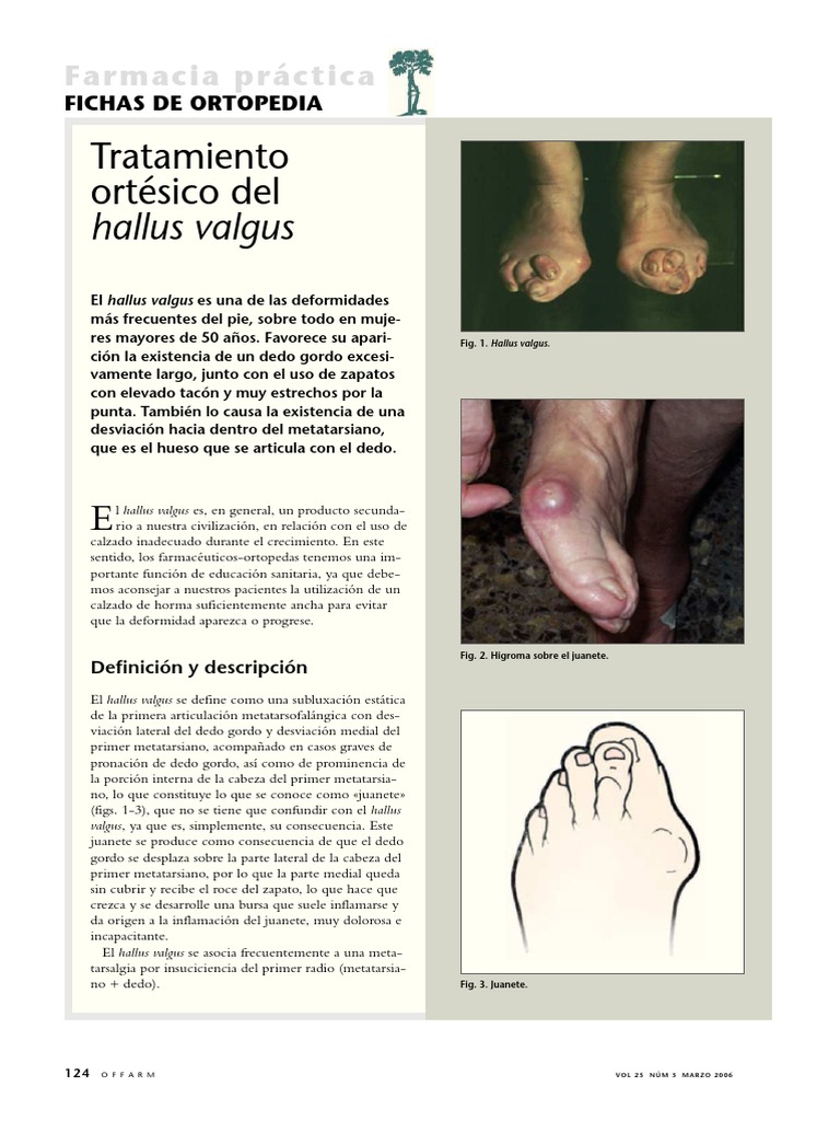 Tratamiento Ortésico Del Hallux Valgus | PDF