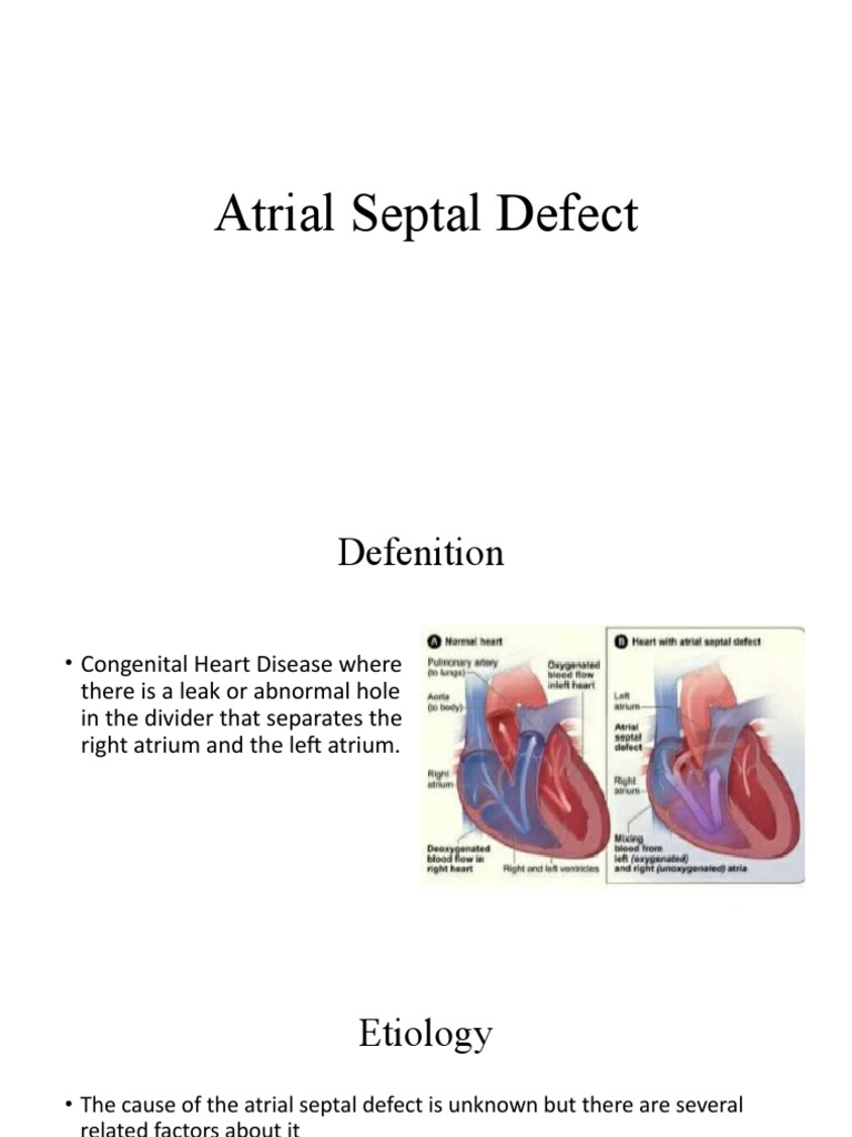 Atrial Septal Defect Overview and Management | PDF | Wellness | Science ...