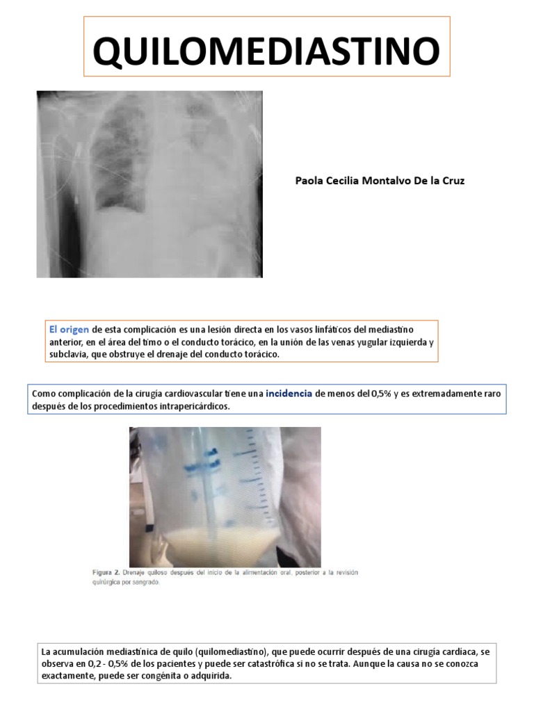 Quilotórax | PDF | Sistema linfático | Cirugía