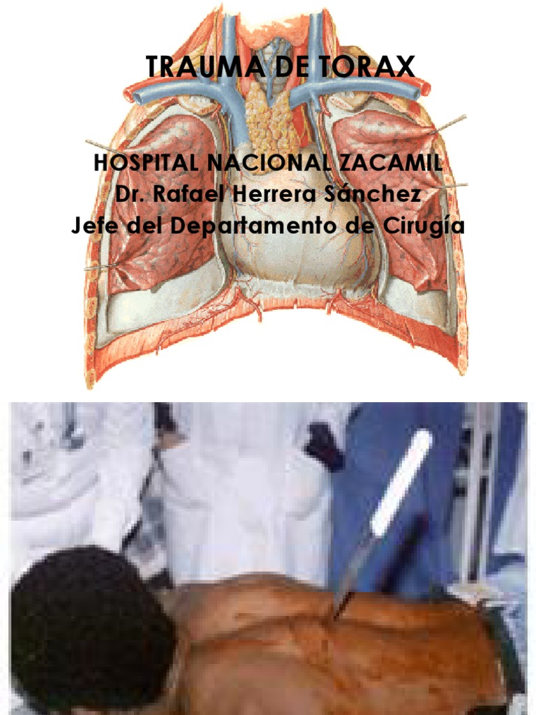 Trauma torácico: evaluación, diagnóstico y manejo | PDF