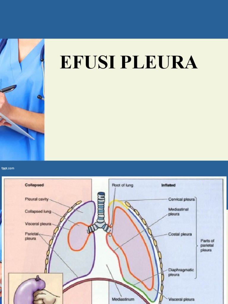 Efusi Pleura | PDF