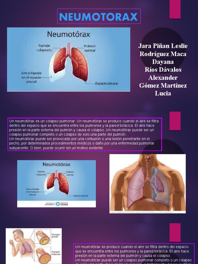Neumotórax: Causas y Tratamientos | PDF | Medicina CLINICA ...