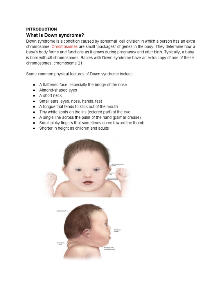 Sample Case Analysis | PDF | Down Syndrome | Congenital Heart Defect