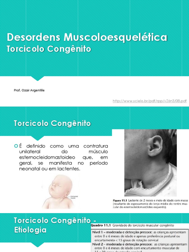 Torcicolo Congênito: Diagnóstico e Tratamento | PDF | Parto | Gravidez