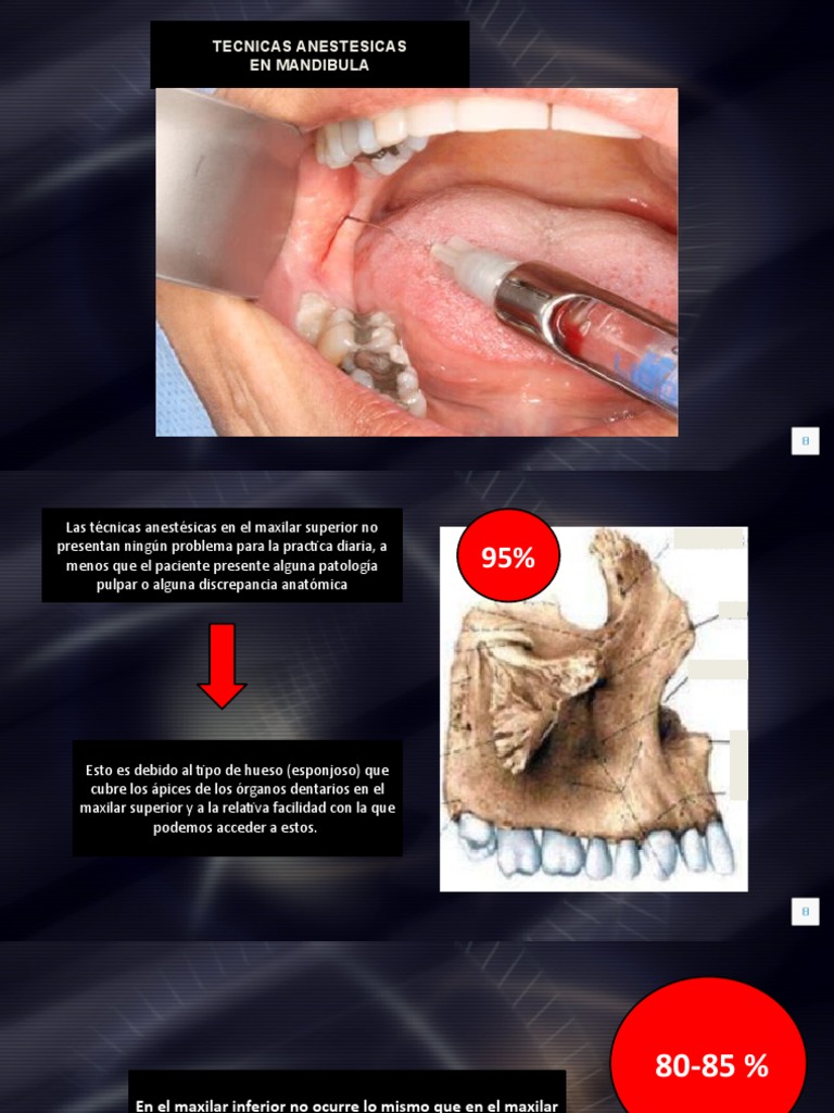 Técnicas anestésicas en mandíbula: bloqueos del nervio alveolar ...