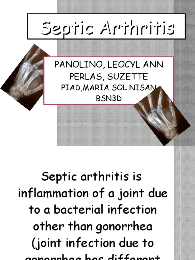Understanding Septic Arthritis Causes & Treatment | PDF