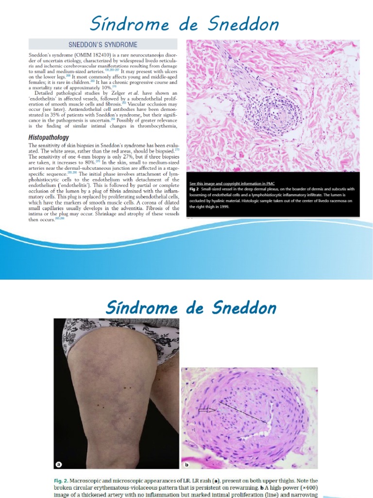 Síndrome de Sneddon y Melanoma. Sesión Derma 27.09.22 PDF | PDF ...