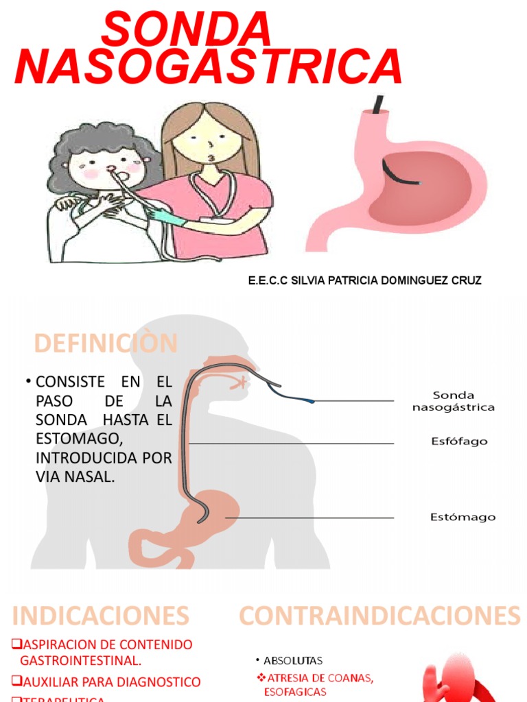 Sonda Nasogastrica | PDF | Enfermedades y trastornos | Gastroenterología