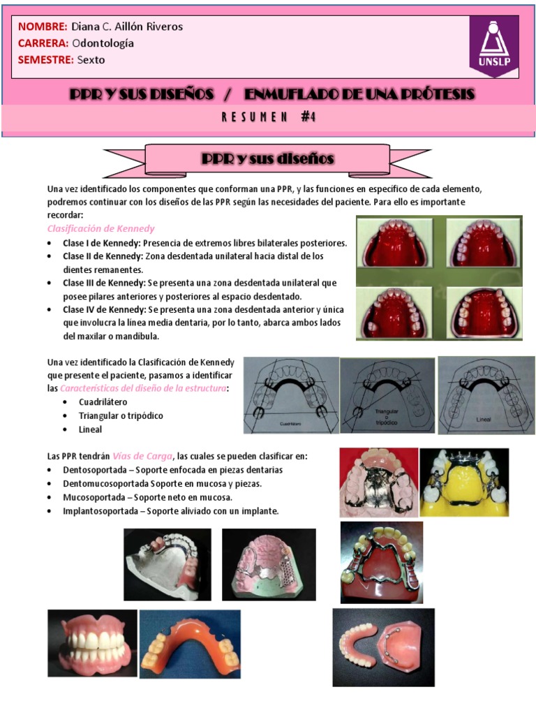 4 PPR y Sus Diseños, Enmuflado de Una Prótesis | PDF | Dentadura postiza