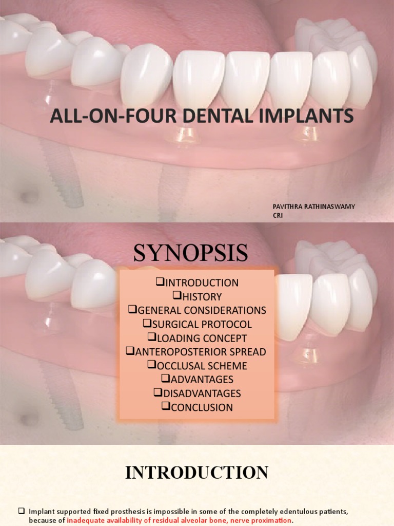ALL-ON-FOUR DENTAL IMPLANTS | PDF | Dental Implant | Dentistry Branches