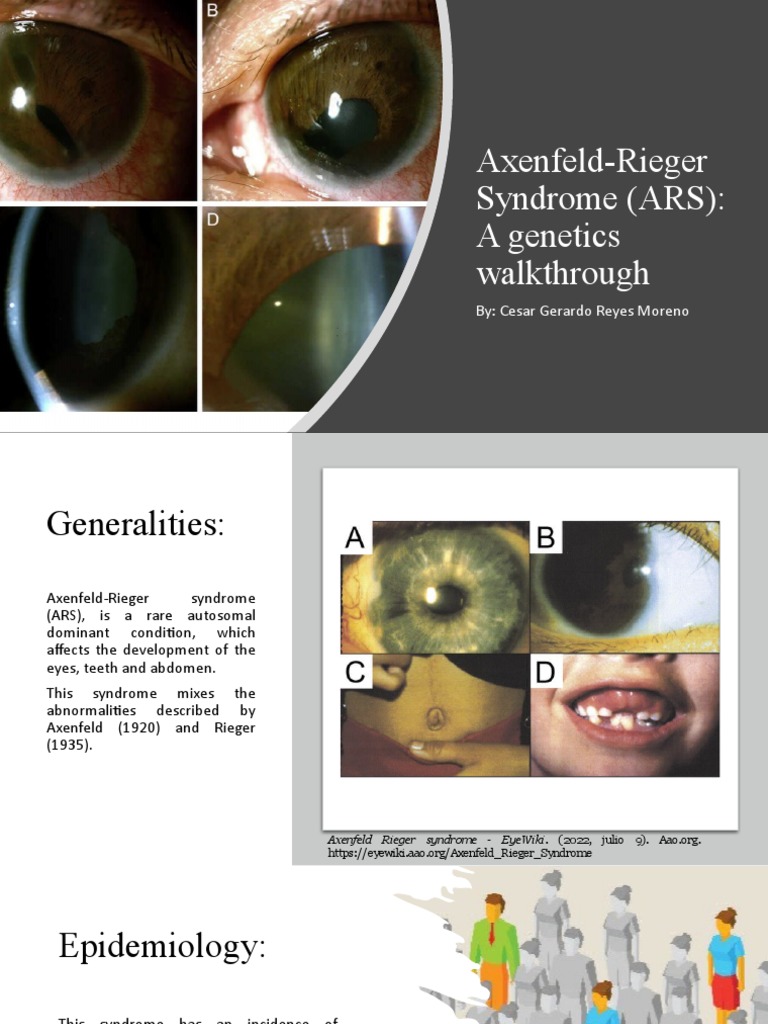 Axenfeld-Rieger Syndrome Overview | PDF | Diseases And Disorders ...