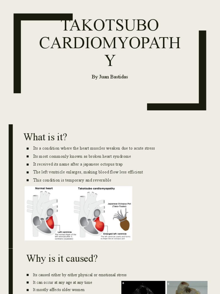 Takotsubo Cardiomyopathy | PDF