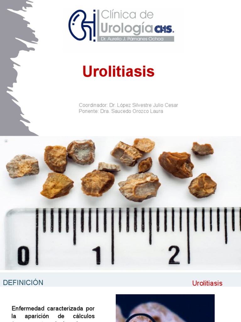 Urolitiasis | PDF | Urología | Especialidades Medicas